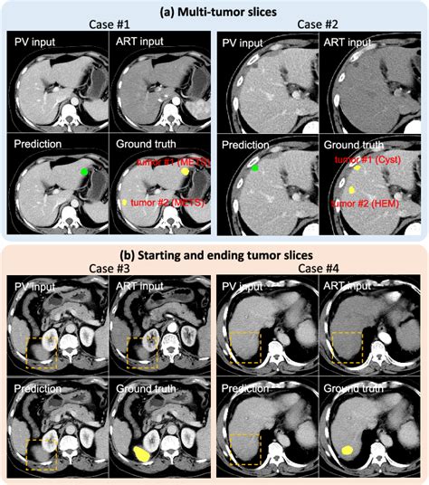 Figure From Multi Modal Tumor Segmentation With Deformable Aggregation And Uncertain Region