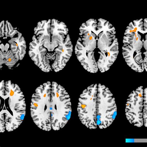 Whole Brain Analysis T Maps Of Brain Activation During Divergent