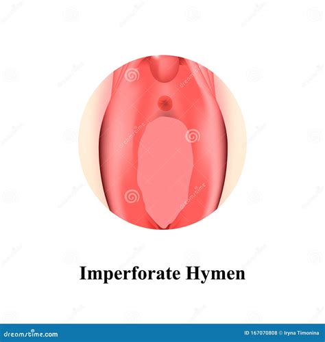 The Structure Of The Vulva Hymen Imperforate Hymen After Defloration Female Genital Organs