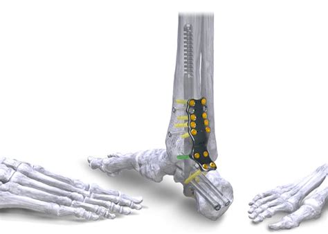 Silverback™ Ankle Fusion Plating System Orb Medical