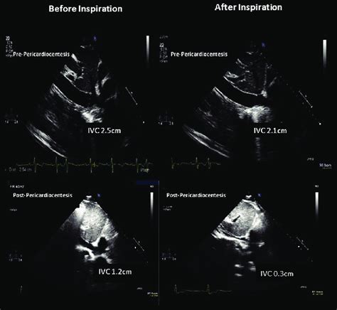 Change In Inferior Vena Cava Collapsibility Index Within H Of Download Scientific Diagram