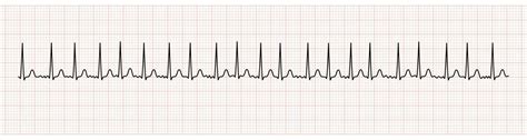 EKG Monitor Showing Atrial Fibrillation With Rapid Ventricular Response