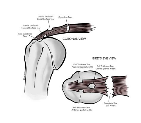 Full Thickness Rotator Cuff Tear