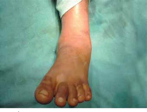 Figure 1 From Closed Pan Talar Dislocation With Posterior Talar Process Fracture Semantic Scholar