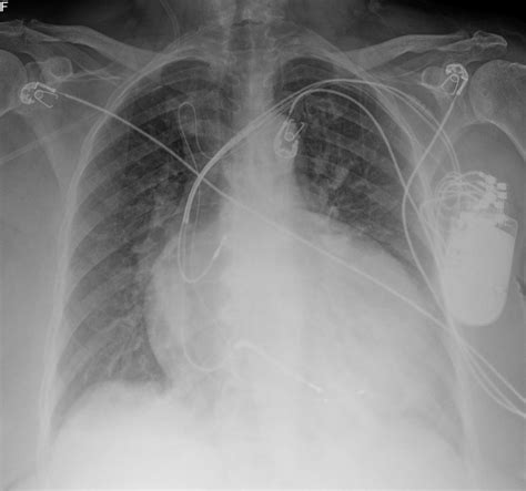 Faces Of Congestive Heart Failure Chf The Common Vein