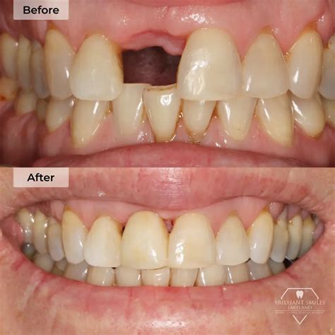 Smile Transformations Brilliant Smiles Lakeland