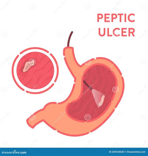 Peptic