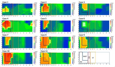Ventricular Activation Time Map In The Brugada Syndrome Group