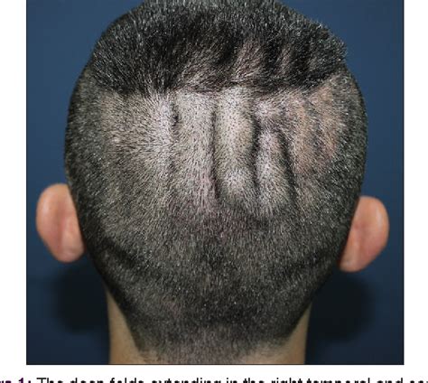 Figure 1 From Cutis Verticis Gyrata Secondary To Cerebriform