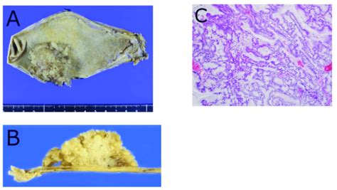 Pathology Of Intracholecystic Papillary Neoplasm Icpn A Grossly Download Scientific