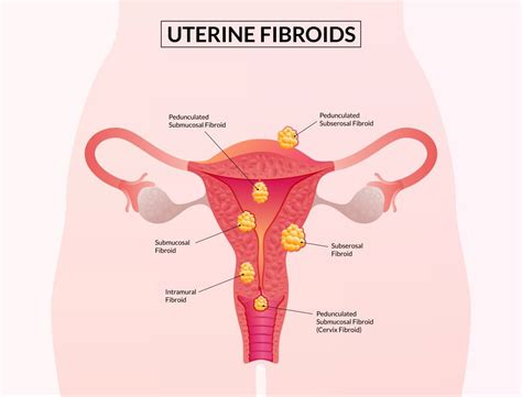 Fibroids And Fertility