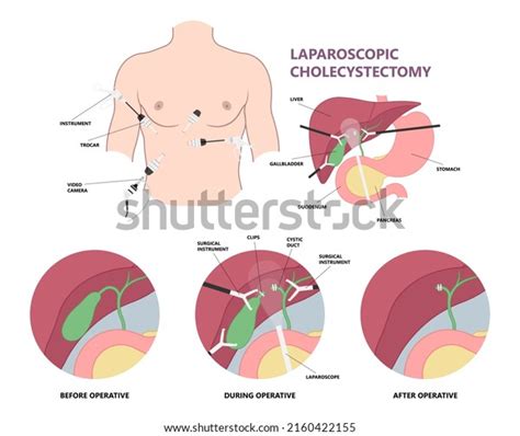 Cholecystostomy Over 16 Royalty Free Licensable Stock Illustrations