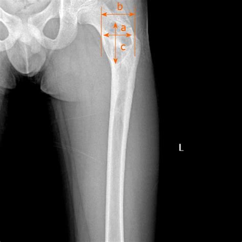 Schematic Illustration Of Lesion Measurement The Lesion To Bone Width