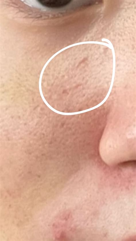 I Went To Rullan Over A Week Ago And I Think Phenol Cross Made My Scar Deeper Scar