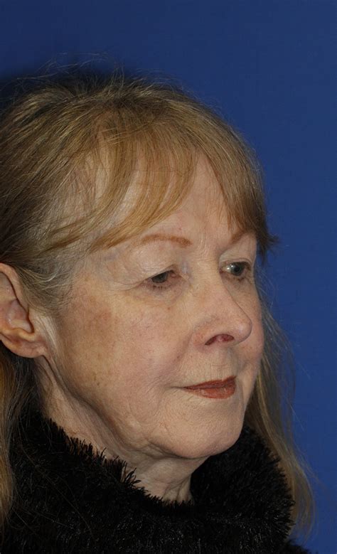 Blepharoplasty Eyelid Surgery Seattle Facial Plastic Surgeon Dr