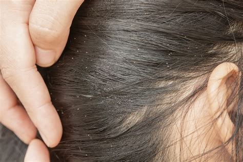 Head Lice Eggs Vs Dandruff