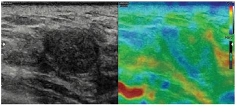 Figure 2 From Added Value Of Strain Elastography In The