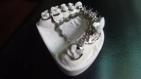 Prótesis Esqueléticas Expadent Laboratorio De Prótesis Dental