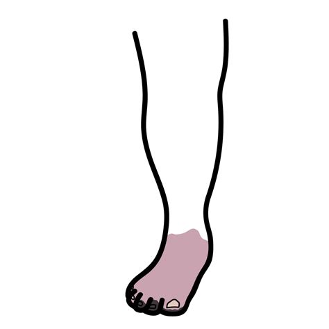 Approach To Upper Gastrointestinal Bleeding Causes Symptoms Melena And Treatment Armando