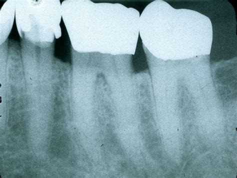 Osce Intraoral Radiography Errors Flashcards Quizlet