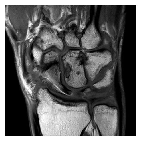 A Ct Scan Showing Consolidated Fracture Of The Scaphoid And
