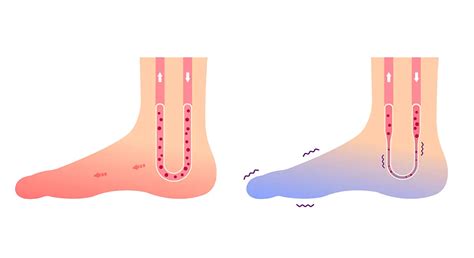 What Are Chilblains Lindsey Ebbs Podiatry