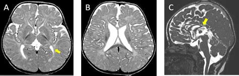 De Novo Mutation And Skewed X Inactivation In Girl With Bcap31 Related