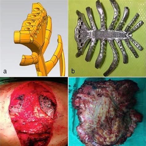 A Sternal Sarcoma Invasion Of The Rib B Left Breast After Cancer