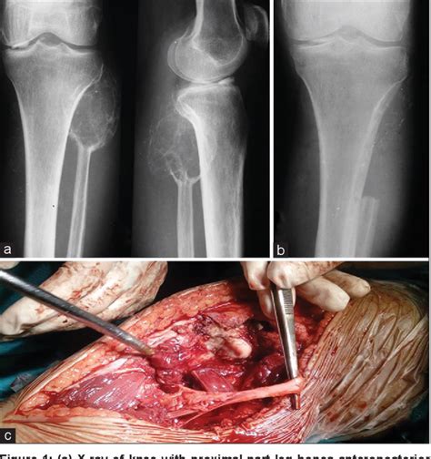 Figure 1 From Fibulectomy For Primary Proximal Fibular Bone Tumors A