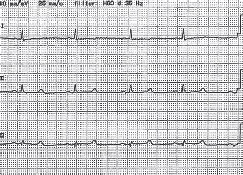 Severe Hypocalcemia And Prolonged QT Interval Due To Denosumab In An Elderly Woman With