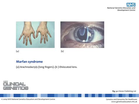 Clinical Photos Autosomal Dominant Conditions Ppt