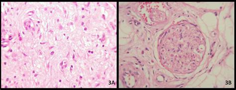 Microscopically Is Observed Fusiform Cell Proliferation With Elongated