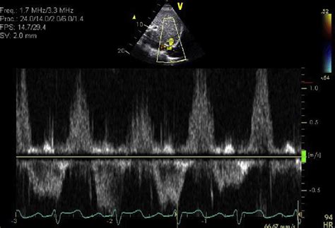 Pulsed Wave Doppler Of The Hepatic Veins Demonstrating Systolic Flow Download Scientific