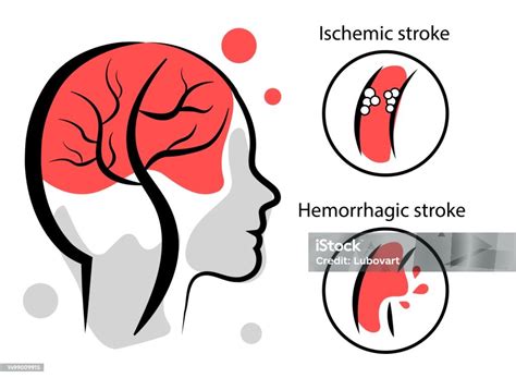 Ischemic Stroke Hemorrhagic Stroke Stock Illustration Download Image