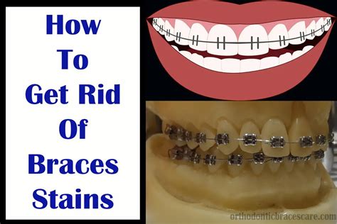 How To Prevent Staining With Braces At Clyde Rucker Blog