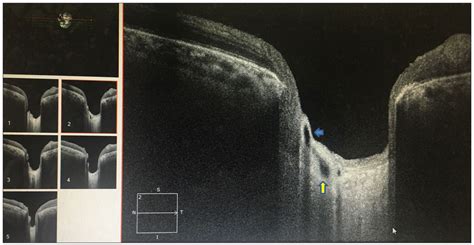 High Definition Oct Images Through The Optic Nerve Head Using The Download Scientific Diagram