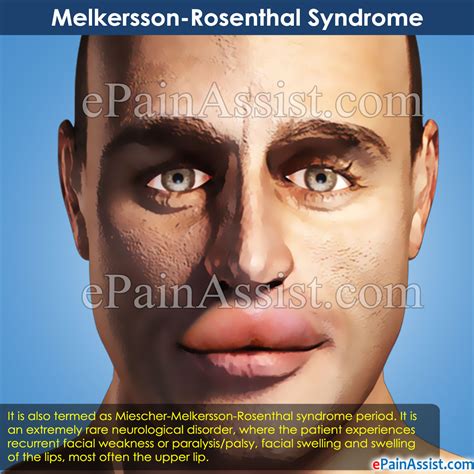 Melkersson Rosenthal Syndromecausessymptomstreatment