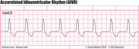 Ecg Educator Blog Six Second Ecg Rhythm Strips