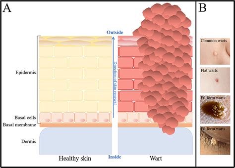 Common Warts Diagram