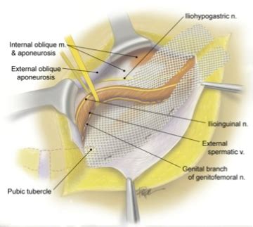 Femoral Nerve Paralysis Following Open Inguinal Hernia Repair