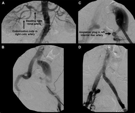 Endovascular Repair Of Left Common Iliac Artery Aneurysm A Abdominal Download Scientific