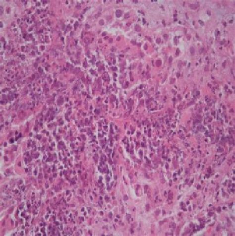 Focus Of Neutrophilic Interstitial Inflammation With Necrotic Debris H