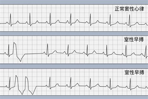 正常心电图的图片 正常标准心电图图片 大山谷图库