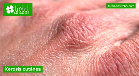 Xerosis Cutánea Qué Es Y Por Qué Se Produce Farmacias Trébol