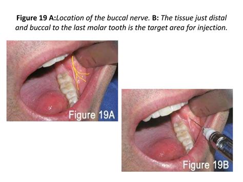 Mandibular Nerve Block Ppt