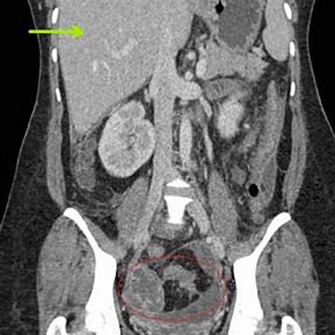 Cect Transverse Cut Pelvis Showing Peripherally Enhancing Septate Download Scientific Diagram