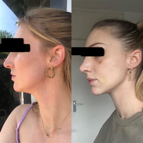 Dealing From Lipo Fibrosis Rplasticsurgery