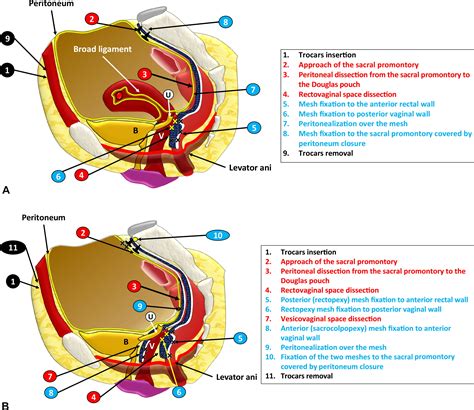 What Is Abdominal Sacrocolpopexy