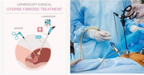 Cost Of Laparoscopy In Nigeria Today All You Need To Know