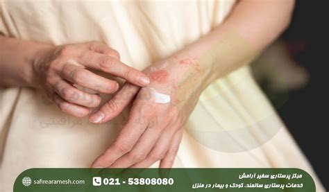 7 روش طلائی برای درمان خانگی اگزمای دست